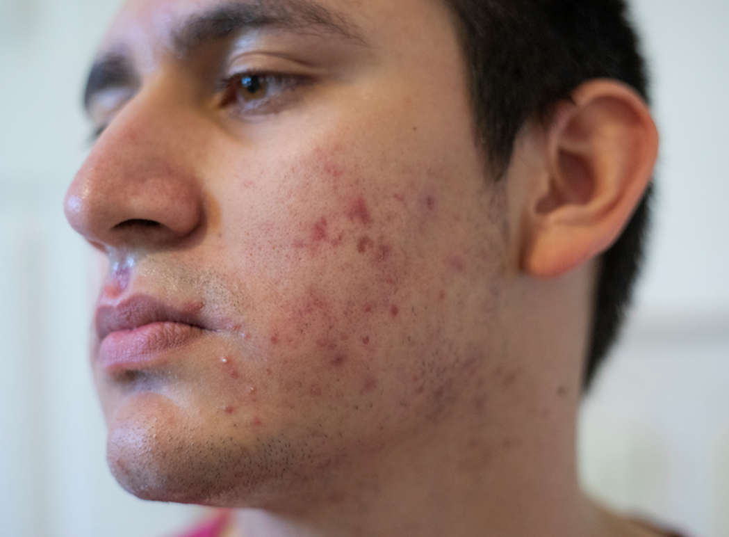 Clear Health - Isotretinoin (Accutane) Prescribed Online and Delivered